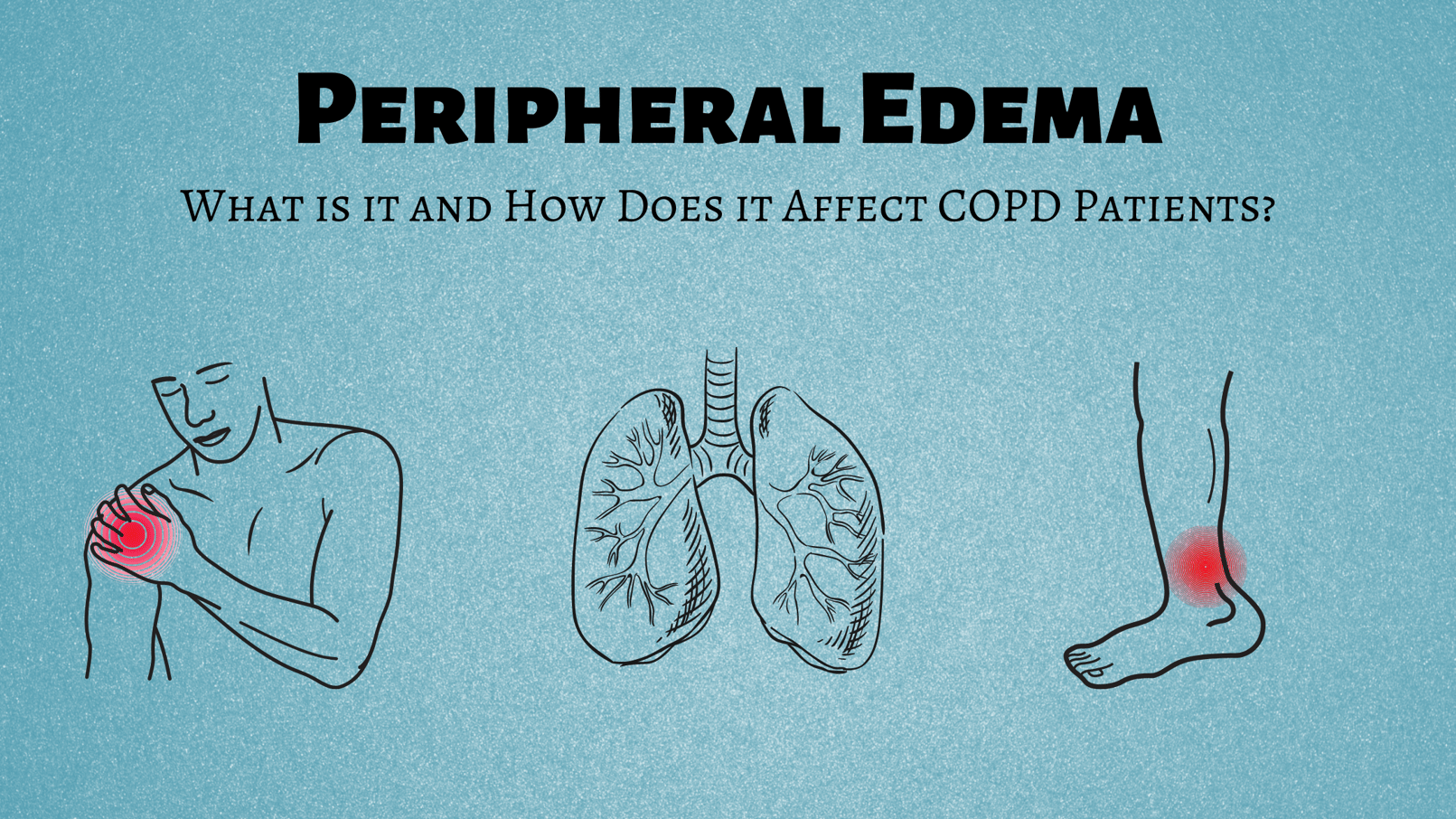 What is Peripheral Edema and Why is it a Concern for COPD Patients?
