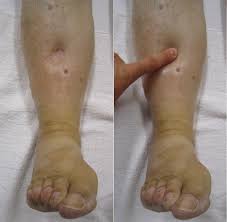 What is Peripheral Edema and Why is it a Concern for COPD Patients?