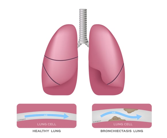 Bronchiectasis: Symptoms, Risk Factors, and Treatment Options