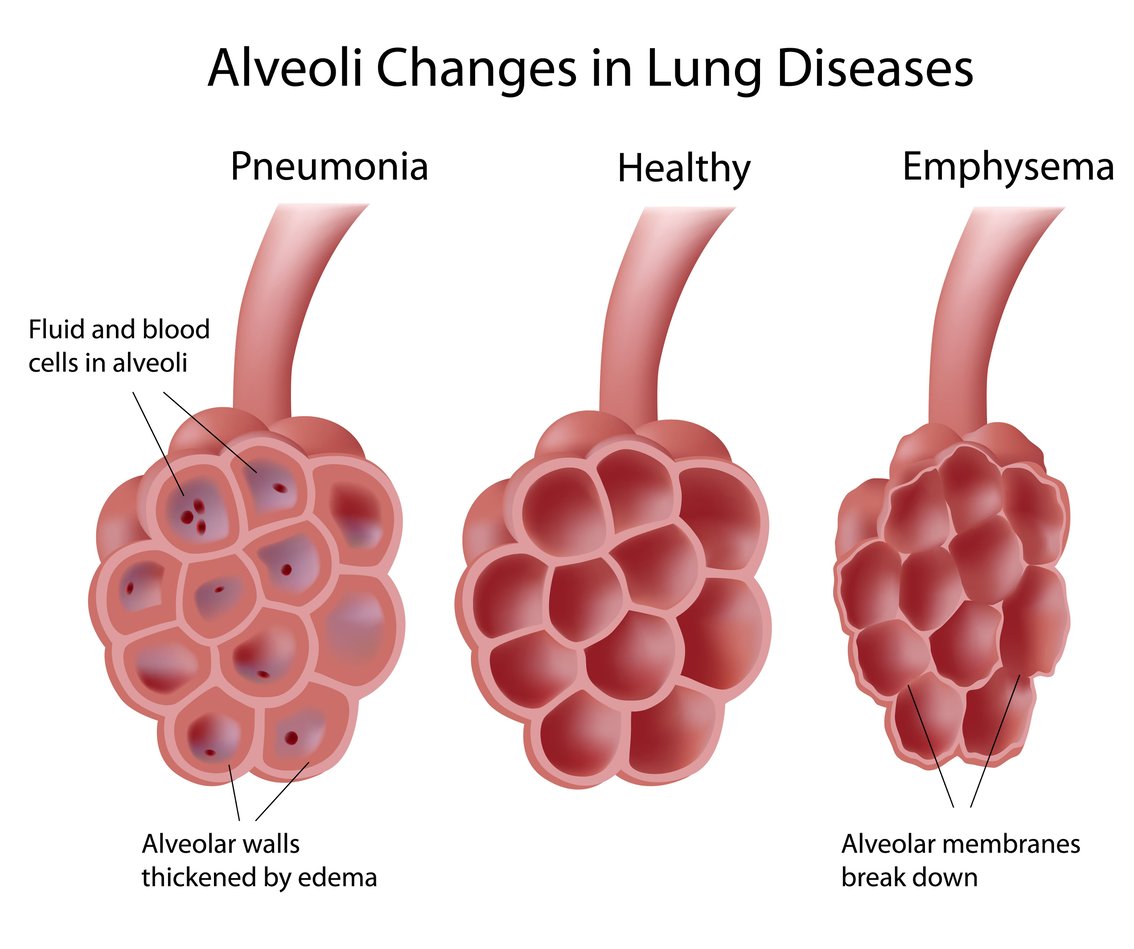An Overview of the Three Types of Emphysema and What Causes Them