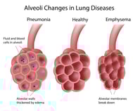 An Overview of the Three Types of Emphysema and What Causes Them