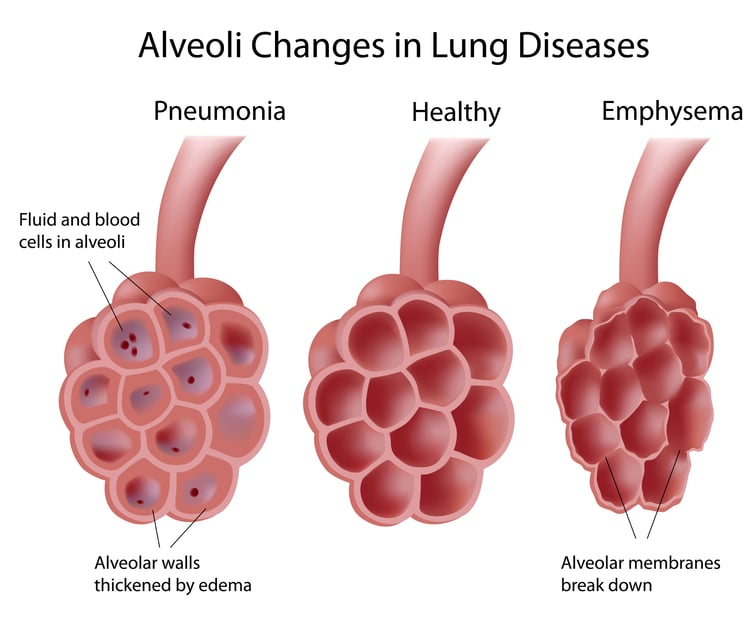 An Overview of the Three Types of Emphysema and What Causes Them
