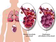 An Overview of the Three Types of Emphysema and What Causes Them