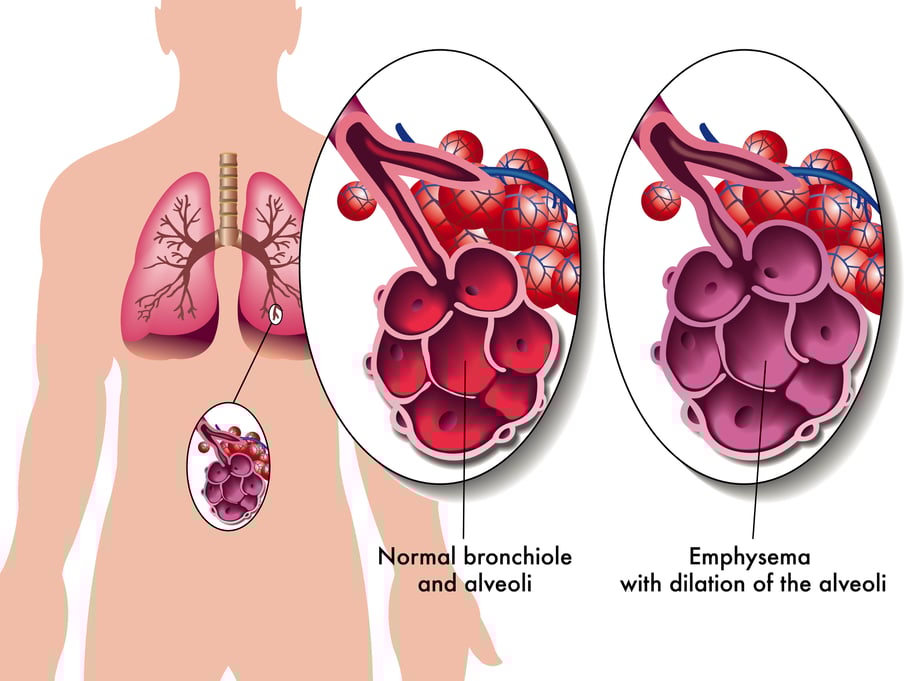 An Overview of the Three Types of Emphysema and What Causes Them