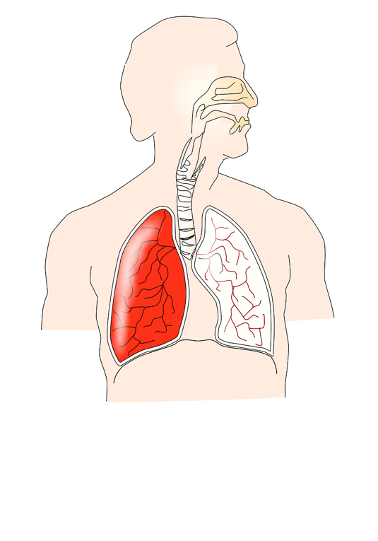 Bronchiectasis: Symptoms, Risk Factors, and Treatment Options